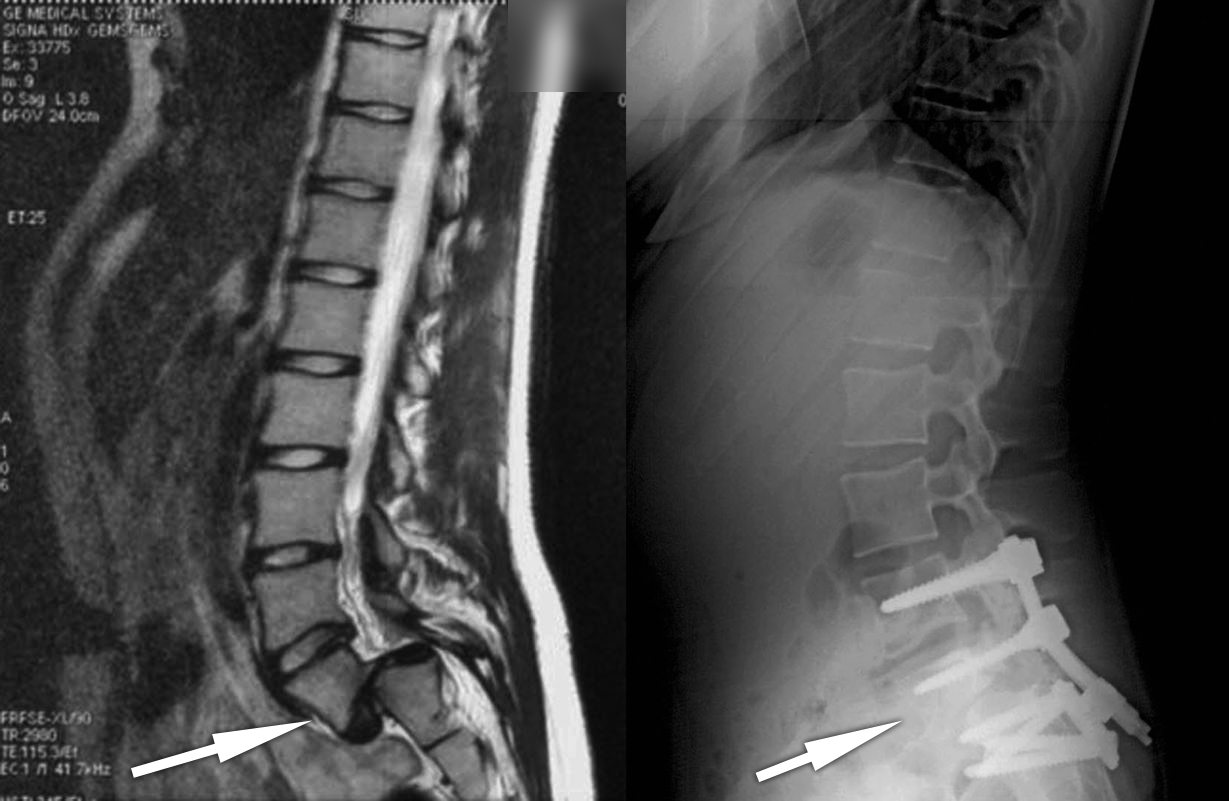 Spondylolisthésis - Docteur Chiffolot - Chirurgie du Rachis